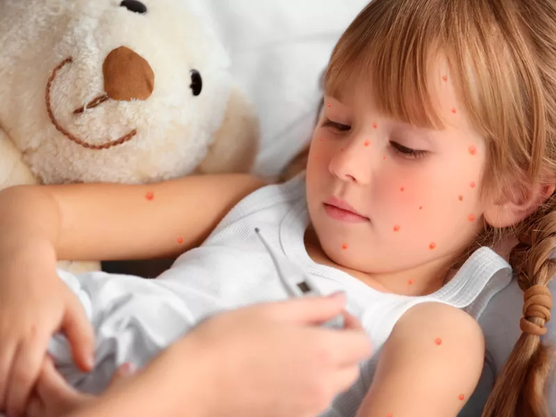 Varicela na criança: tudo o que deve saber | O Meu Bebé