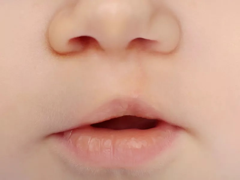 Lábio leporino e palato fendido | O Meu Bebé